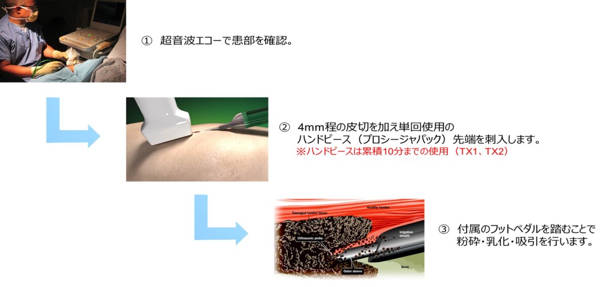 超音波吸引器 TENEX HEALTH TX System | 製品情報 | エム・シー・メディカル株式会社