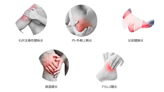 超音波吸引器 TENEX HEALTH TX System | 製品情報 | エム・シー・メディカル株式会社